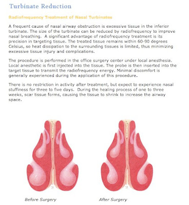 Danielle's Brain Bits: ENT Adventures - Turbinate Reduction