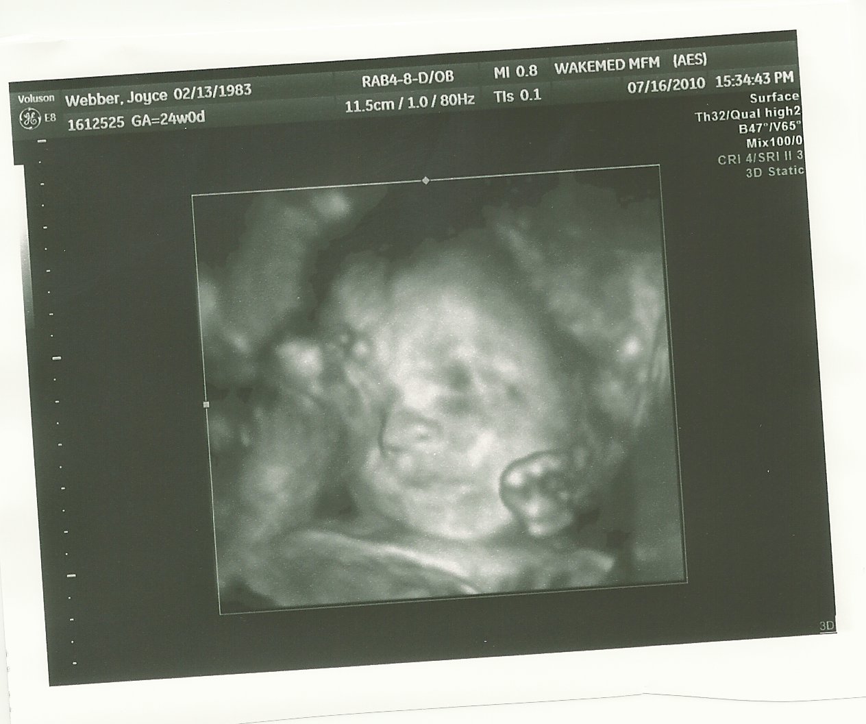 Two for One Special: 24 Week Ultrasound