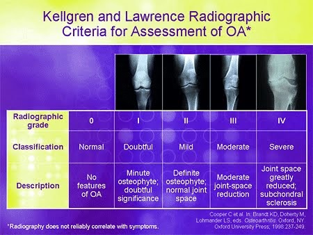 Strike It Up: Kellgren-Lawrence Grading Scale