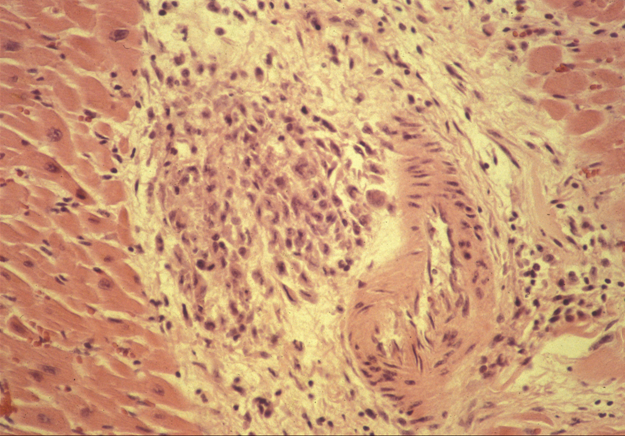 rheumatic nodule - meddic