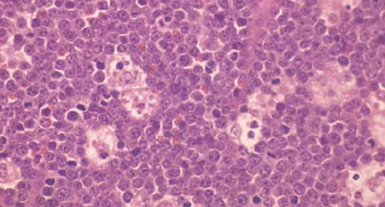 Doctors Network: BURKITT’S LYMPHOMA.