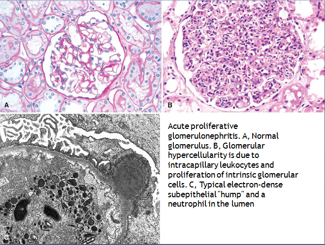 proliferative glomerulonephritis - meddic