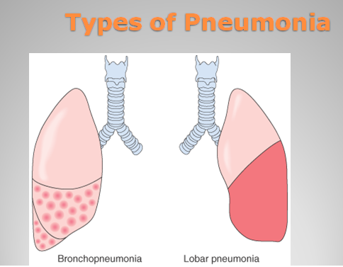 MBBS Medicine (Humanity First): Types of Pneumonia.