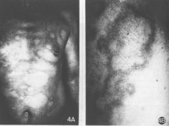 Hanseníase - Enfermagem online - blog da enfermagem