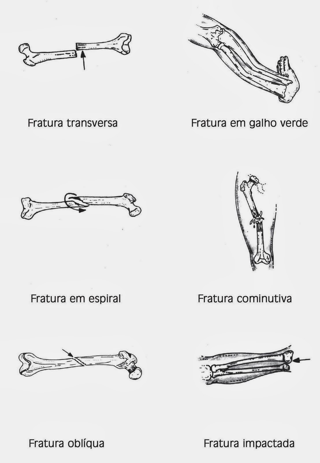 Fraturas - Enfermagem online - blog da enfermagem