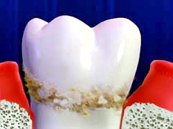 la salud en tus dientes: CALCULO DENTAL
