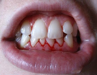 Dentist Online: Gusi Berdarah-Mulut berbau-Gigi Goyang