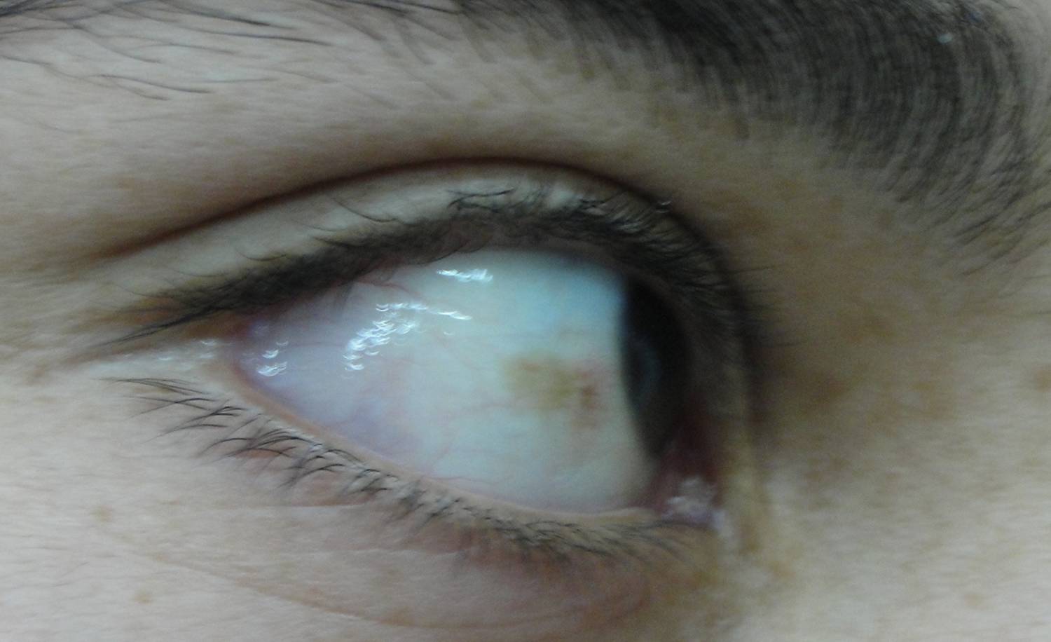 Medicina APS: Niña de 15 años con Manchas Café con Leche