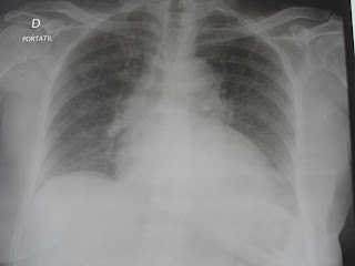 Medicina APS: Hombre de 73 años con Disnea