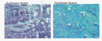 Pompe disease - the real story: Novazyme's results