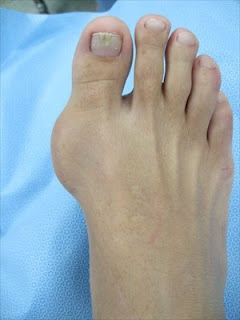 Podo Basas al Día: Hiperuricemia (gota).Hallux Valgus.Desastres a ...