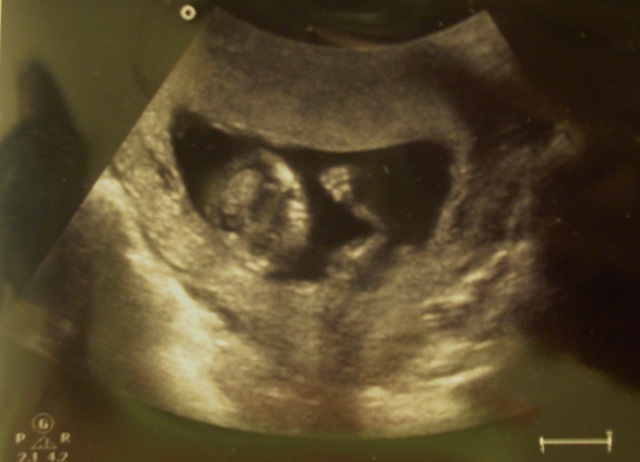 Miscarriage 7 weeks, Stillbirth 19 weeks, and Hope for a new life!