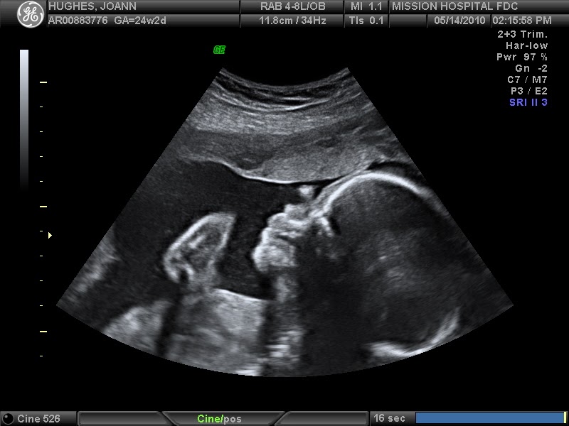 Hughes Family: 24 Weeks Ultrasound