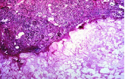 Patologia Geral - Necrose - Tipos especiais ~ Life Pet - Portal Acadêmico