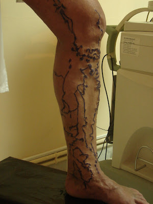 Operatii Varice, Varice, Tratament Varice, Vase Sparte,: Boala Varicoasa