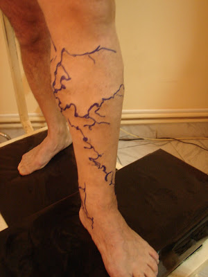 Operatii Varice, Varice, Tratament Varice, Vase Sparte,: Boala Varicoasa