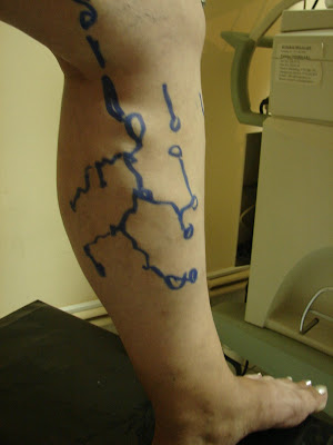 Operatii Varice, Varice, Tratament Varice, Vase Sparte,: Boala Varicoasa