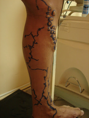 Operatii Varice, Varice, Tratament Varice, Vase Sparte,: Boala Varicoasa