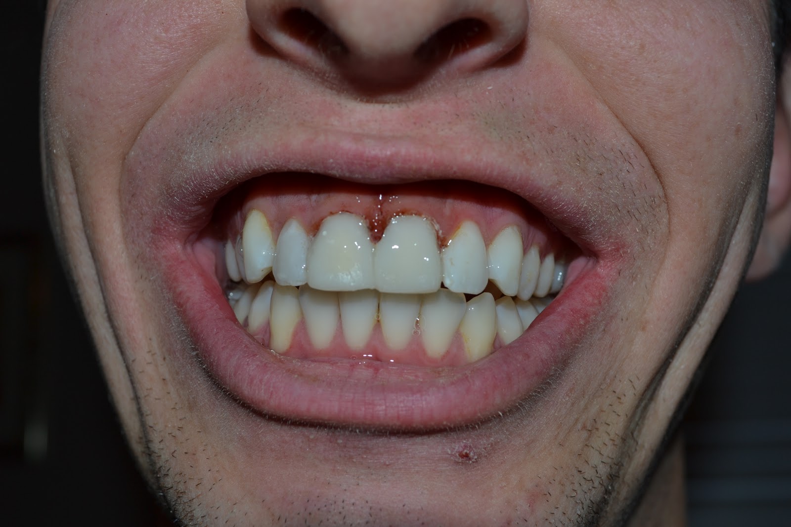 Brian, Anna, Lydia and Adeline: Day 60! Toothless...