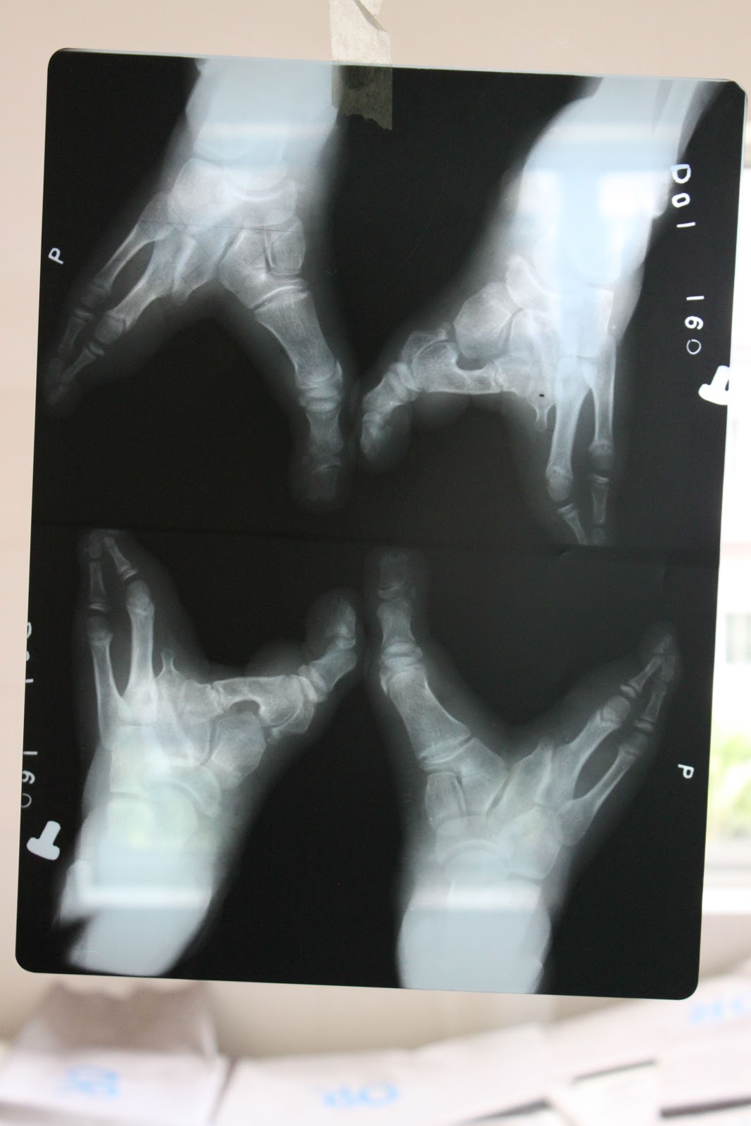 Ectrodactyly X Rays