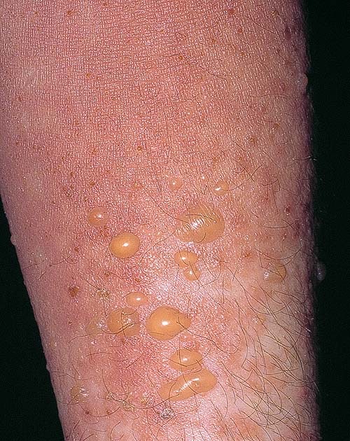 Rural Medicine Today: Dermatology: Blistering Diseases