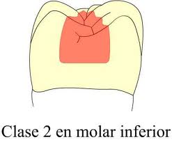 Cavidades de Black: Clase II