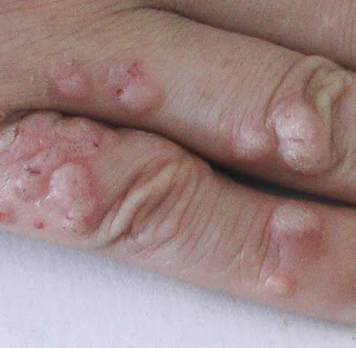 pictures of warts: pictures of warts