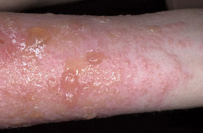 Medical Students Blog: Contact Dermatitis