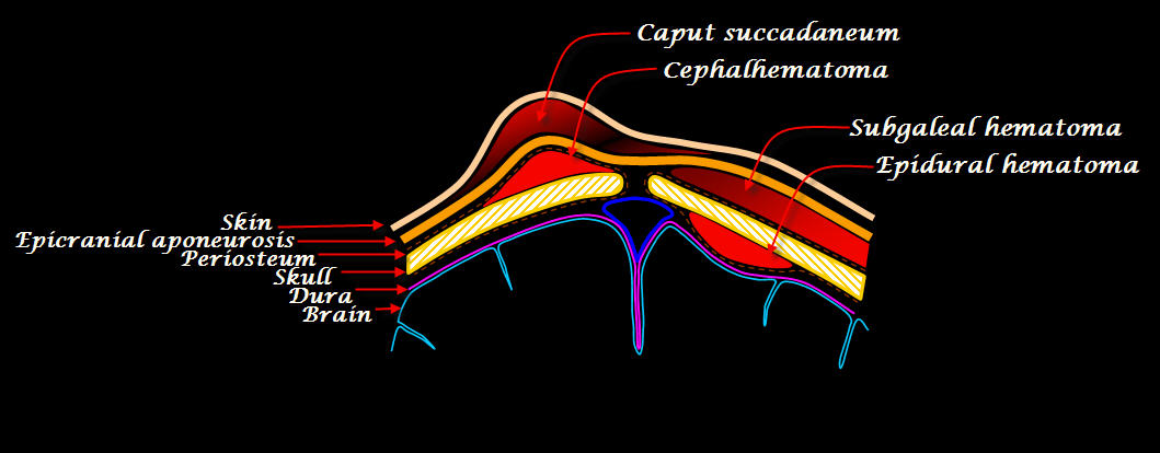 Win Win paradise: Caput succedaneum