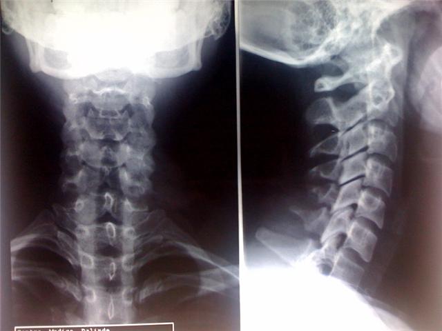 radiologia general: Columna Cervical Ap y Lat