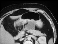 Medical Lecture Notes Online: Pancreatic Pseudocyst