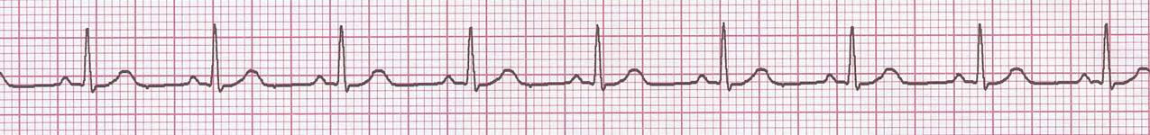 Medical Lecture Notes Online: ECG 3-Normal Sinus Rhythm (NSR)