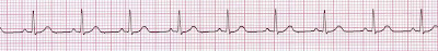 Medical Lecture Notes Online: ECG 3-Normal Sinus Rhythm (NSR)