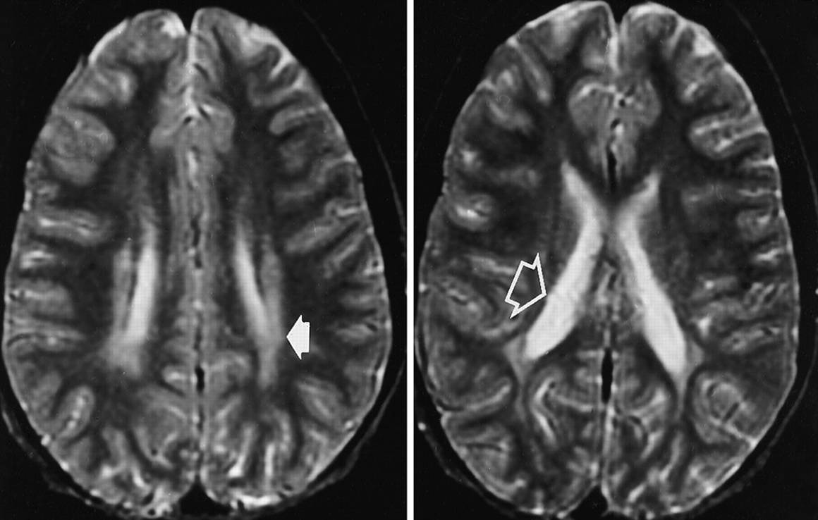 Medical Lecture Notes Online: Cerebral Palsy