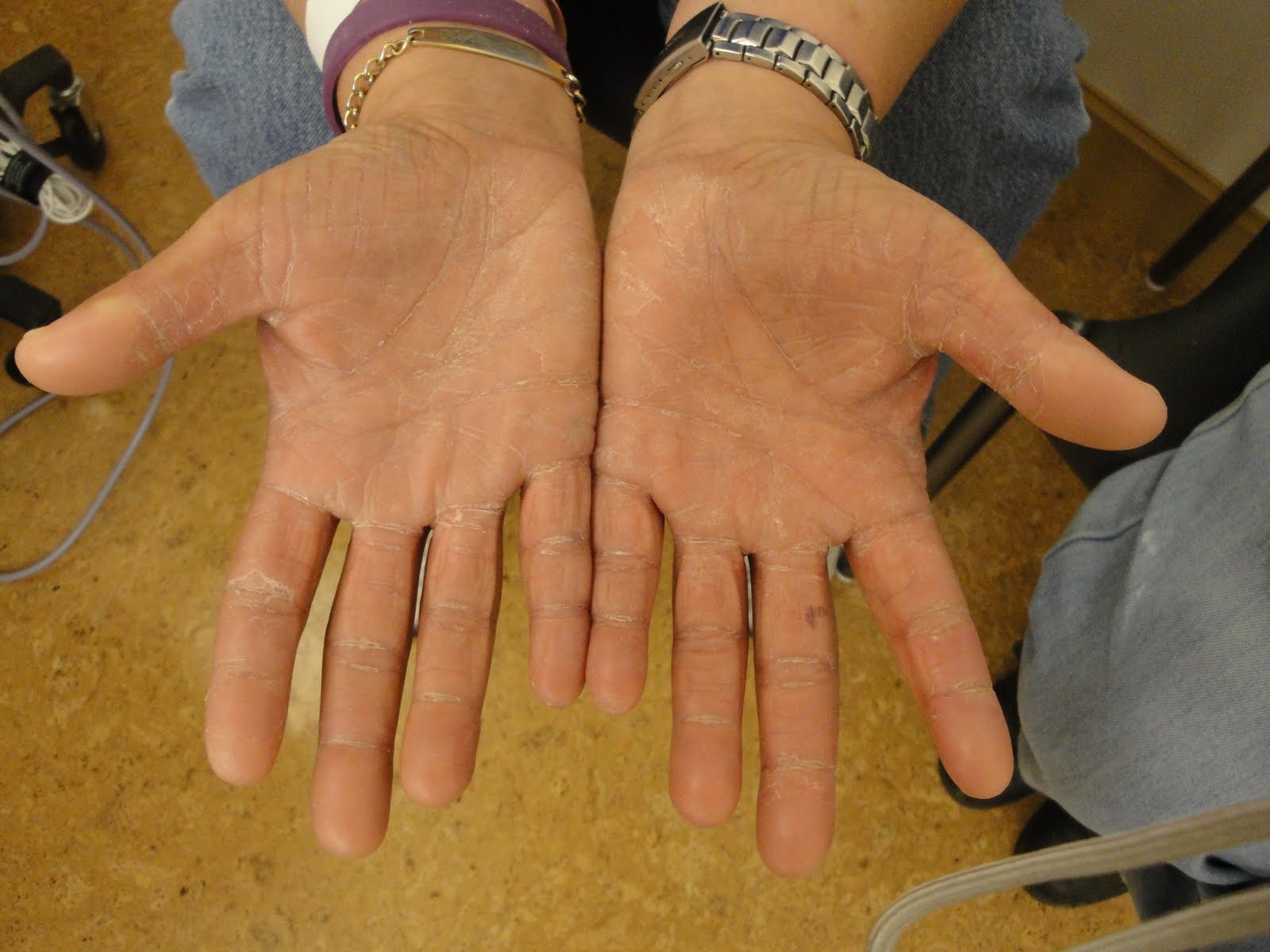 VIRTUAL GRAND ROUNDS IN DERMATOLOGY 2.0: Palmoplantar ...