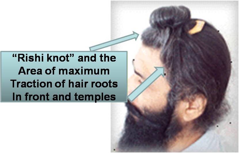 Good Bye Hair Loss - Hair Loss Tips & Advice Online: Turban Alopecia in ...