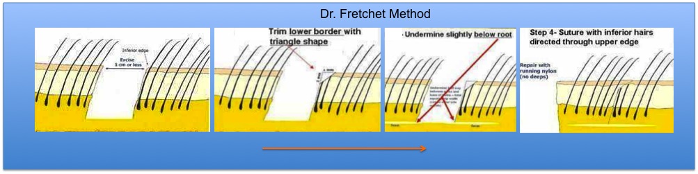 Good Bye Hair Loss - Hair Loss Tips & Advice Online: Trichophytic Closure