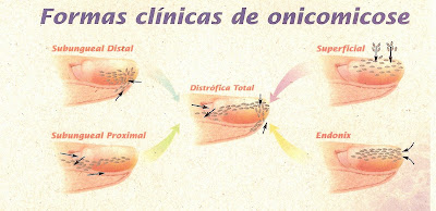 Armário do Sintonya Cabelo e Estetica: Onicomicose