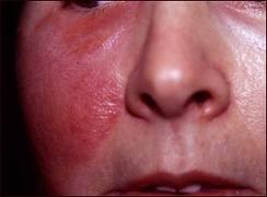 enfermedades: ERISIPELA