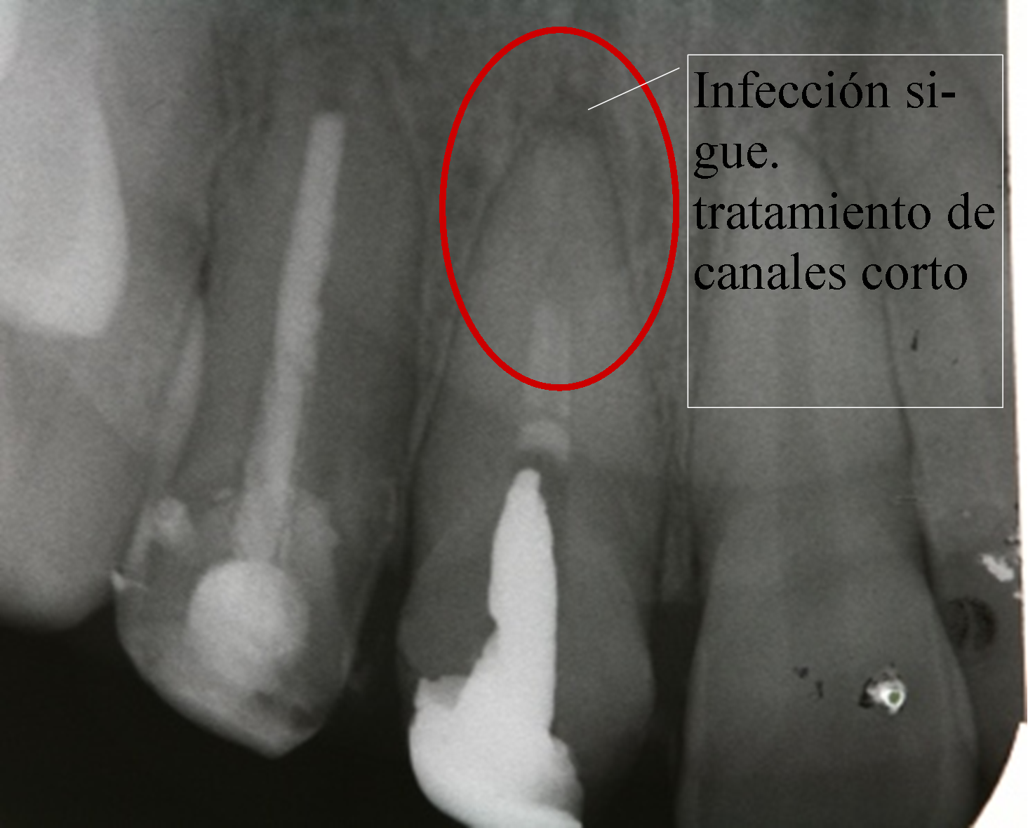 TRATAMIENTOS DENTALES: El Retratamiento de Canales