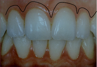 TRATAMIENTOS DENTALES: Y la encía...¿Para qué sirve?