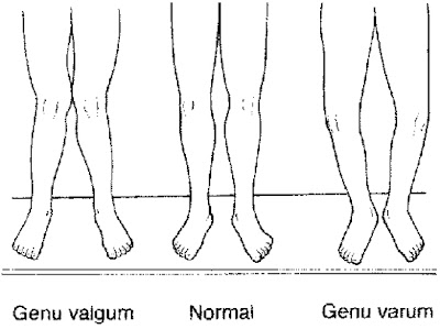 Genoux arqués vers l'interieur