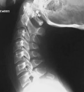 CT/MRI PATHOLOGY BLOG: Clay-Shoveler's Fracture