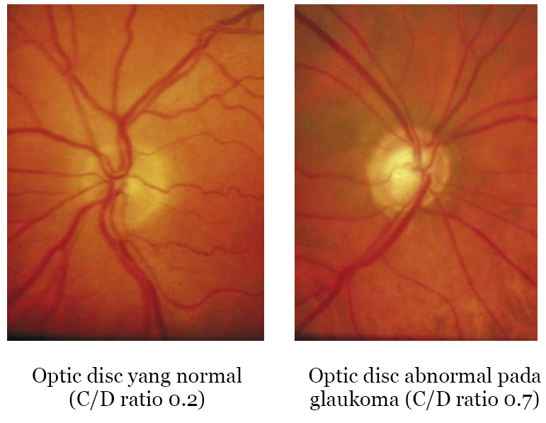 MEDICAL BLOG: Glaukoma Kronik