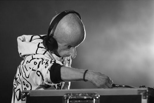 Progeria: An Inspiration: Celebrity with Progeria