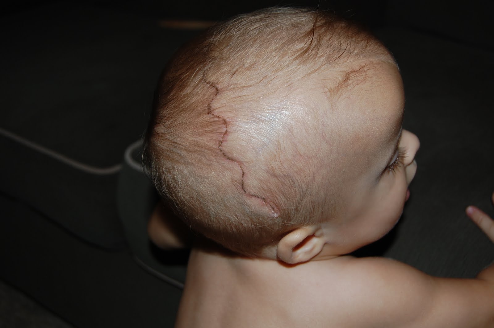 Landon's Journey with Lambdoid Synostosis: 4 Weeks Post Surgery!