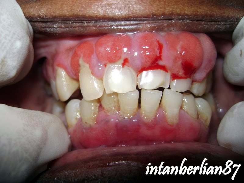 Multiple periodontal abscess in diabetic patient berserta gambar | Bila ...