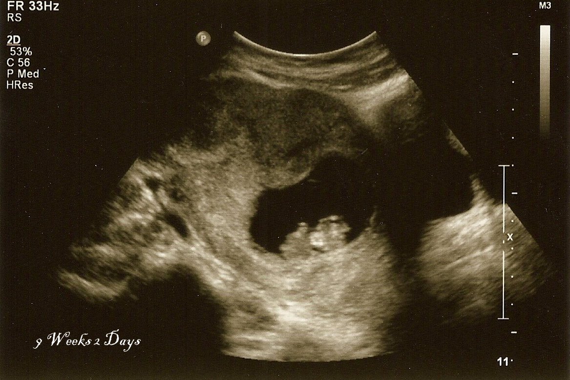 Monkey Tales: 9 weeks 2 days with ultrasound pics!!!