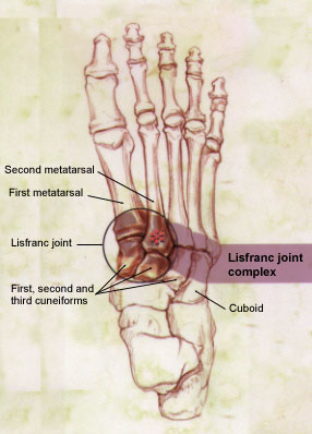 Dr. Knight's Insights: Who is Lisfranc? What is a Lisfranc injury?