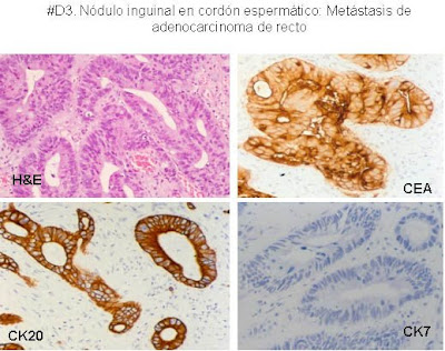Tecnología Médica Mención Morfofisiopatología y Citodiagnóstico: CEA ...